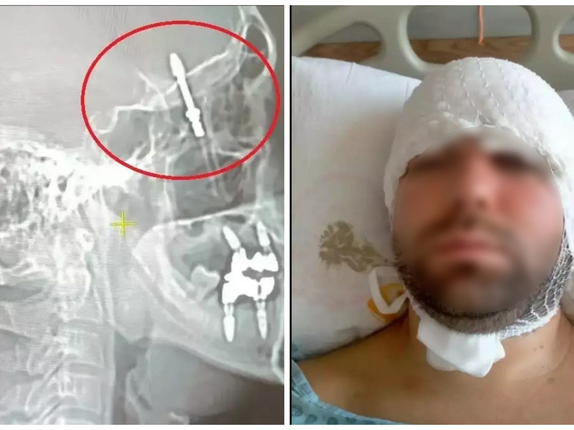 Dentista Sbaglia E Stringe Troppo Entra Con La Vite Nel Cranio